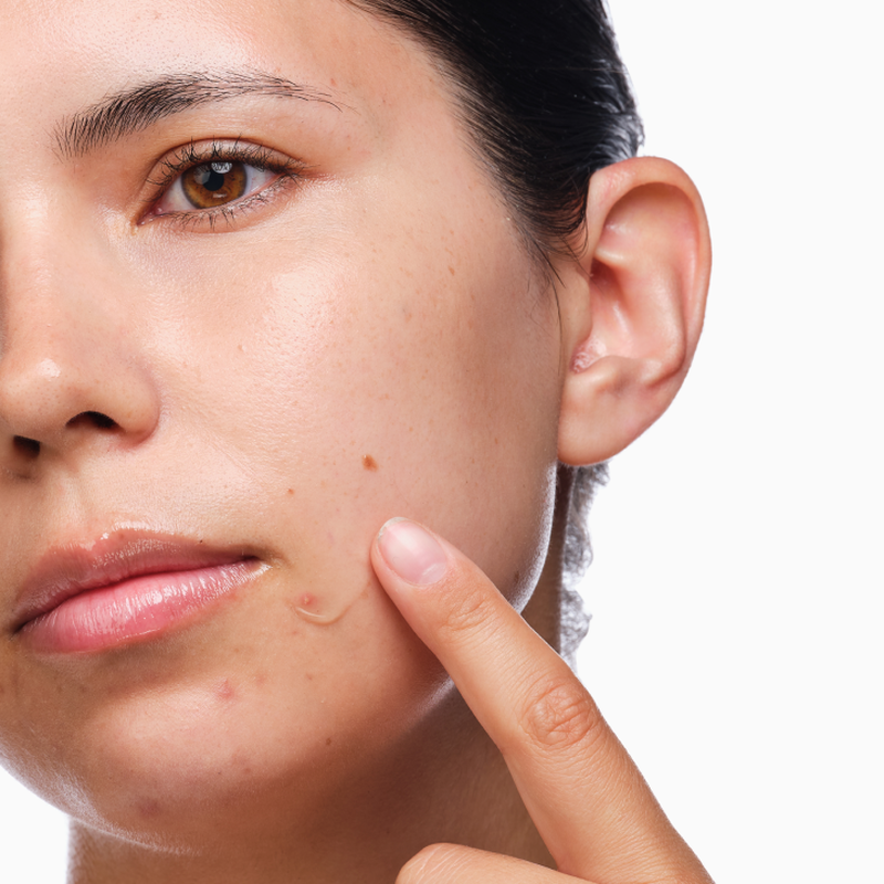 The Acne Set: Salicylic Acid 2% Regimen for Clear Skin